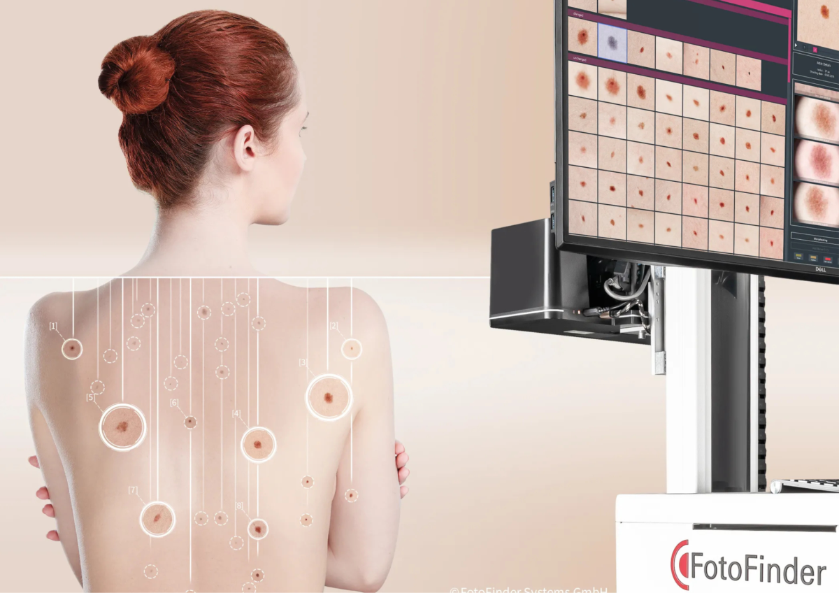 Mole Mapping - The International Health Centre The Hague